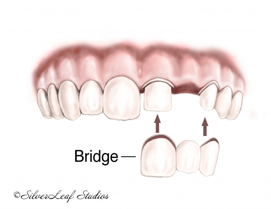 Treasure Valley Endodontics Extraction Grafting Dental Implants
